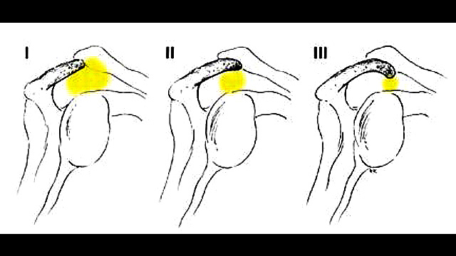 Shoulder Injury Types